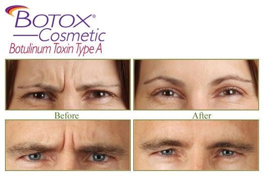 Micro Botox | Natural, Subtle Anti-Aging Treatment | Affordable for ...